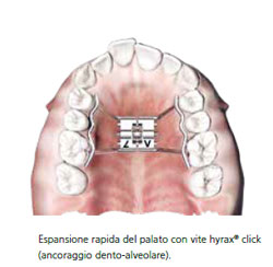 Espansore rapido del palato